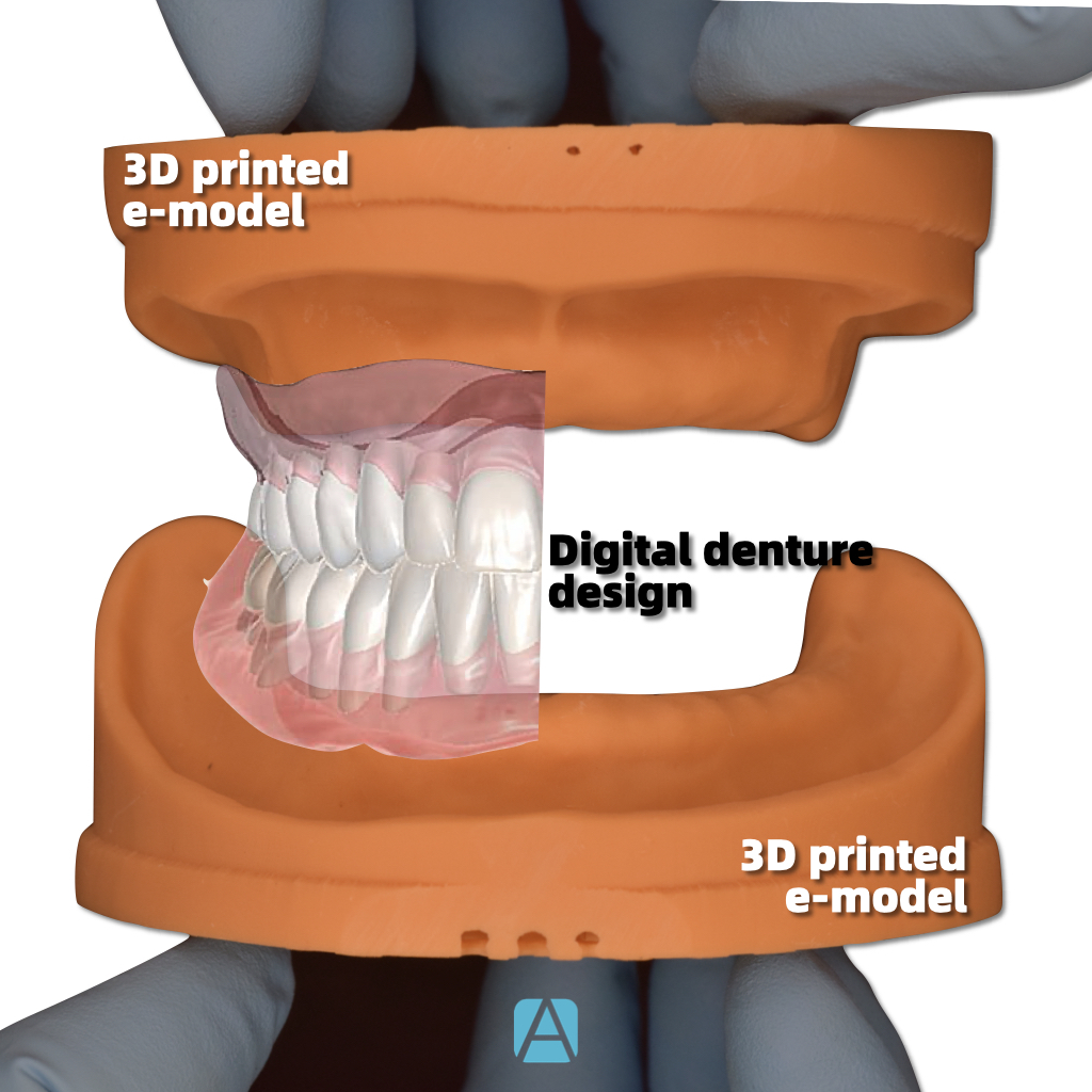 How to do dentures digitally - based on intraoral scanning edentulous patients - Arklign